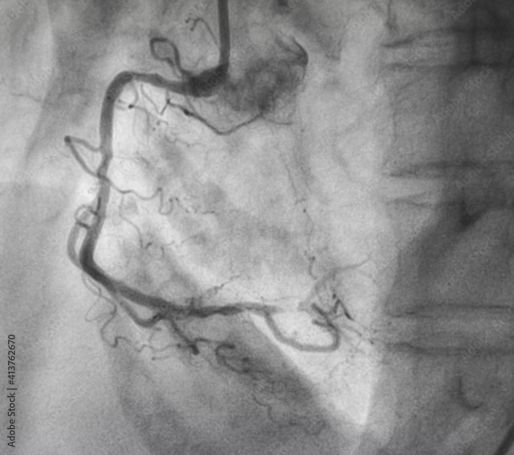 Coronary angiogram , medical x-ray for heart disease. Coronary artery ...