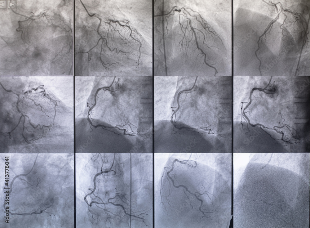 Coronary angiogram , medical x-ray for heart disease. Coronary artery ...