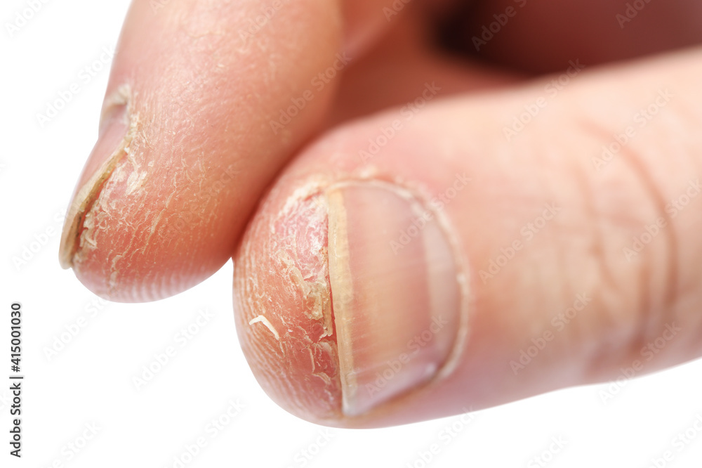 Atopic dermatitis (AD), also known as atopic eczema, is a type of skin ...