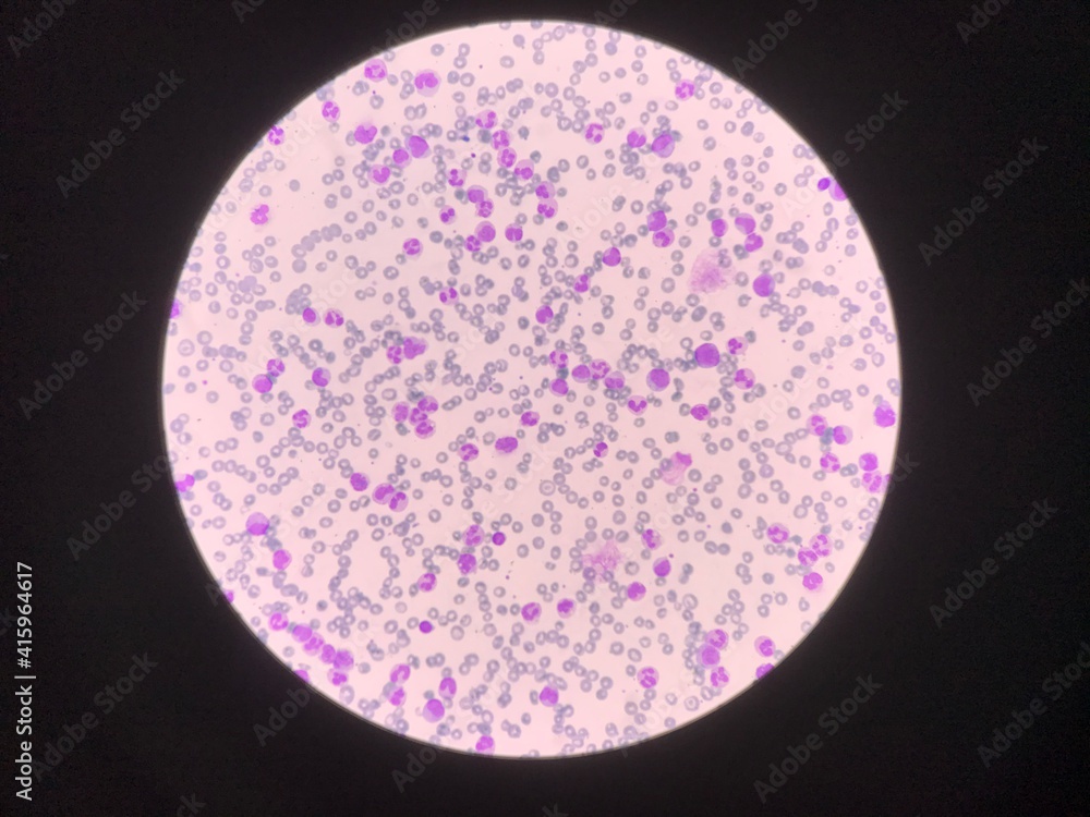 ภาพถ่าย Stock Immature and mature white blood cells.Segmented ...
