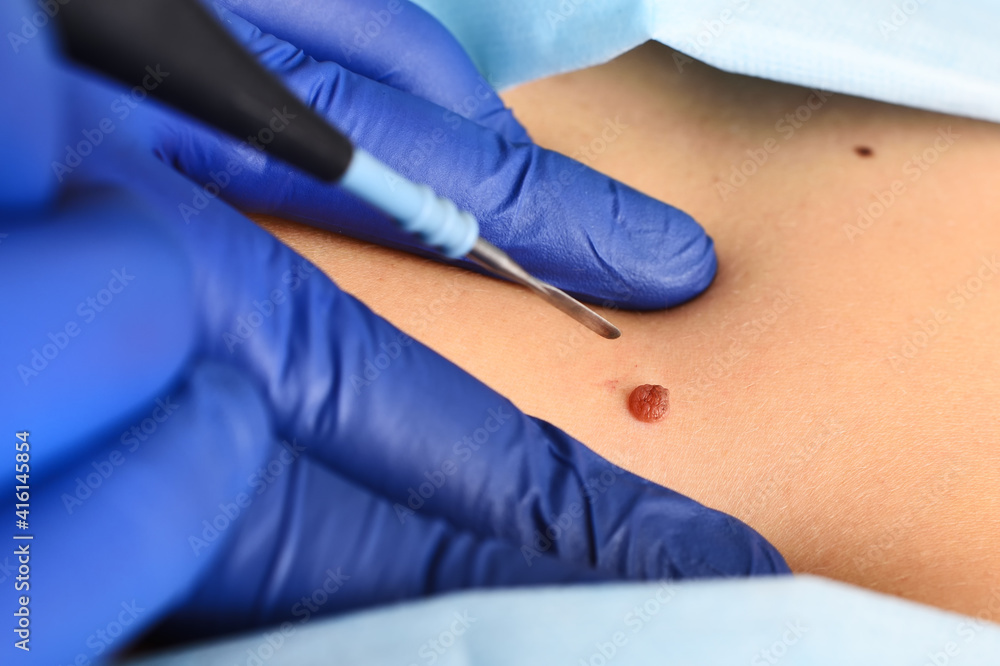 A dermatologist surgeon removes a neoplasm - a mole or nevus from the ...