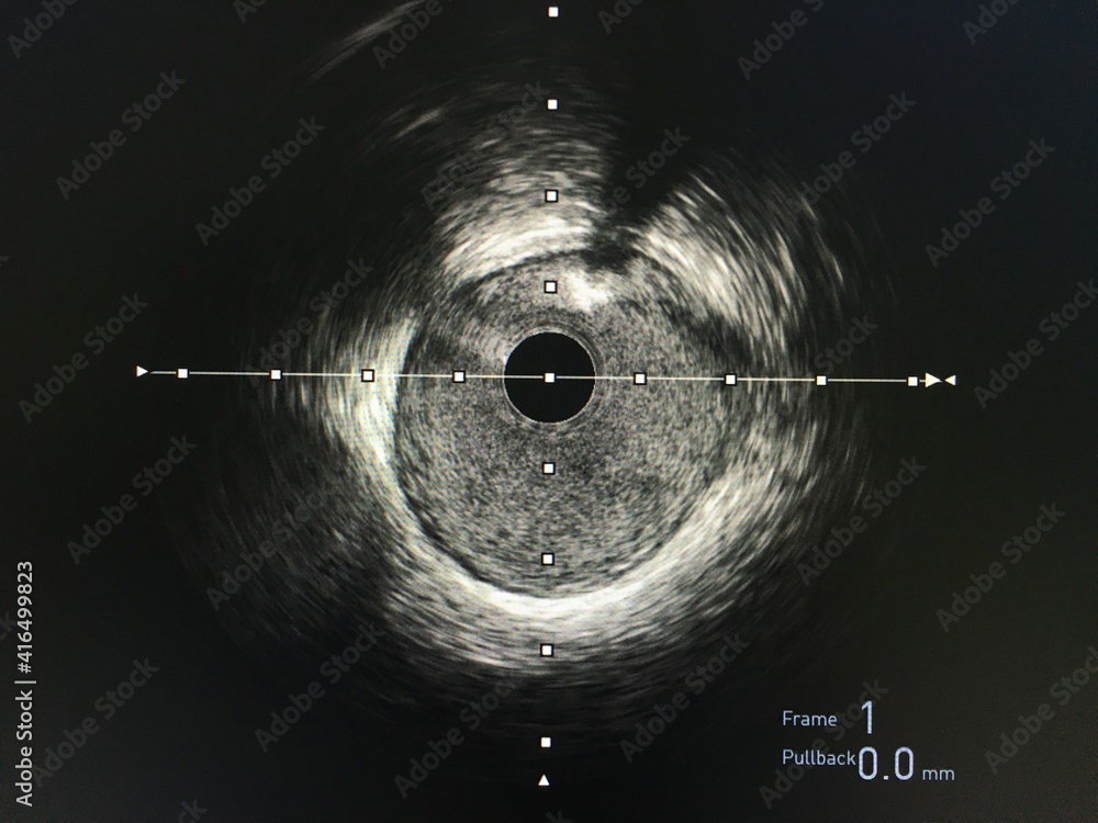 Intravascular ultrasound imaging (IVUS) at cardiac catheterization ...