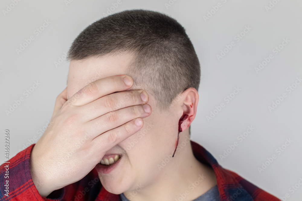 A man whose ear is bleeding. Vascular rupture, damage to the tympanic ...