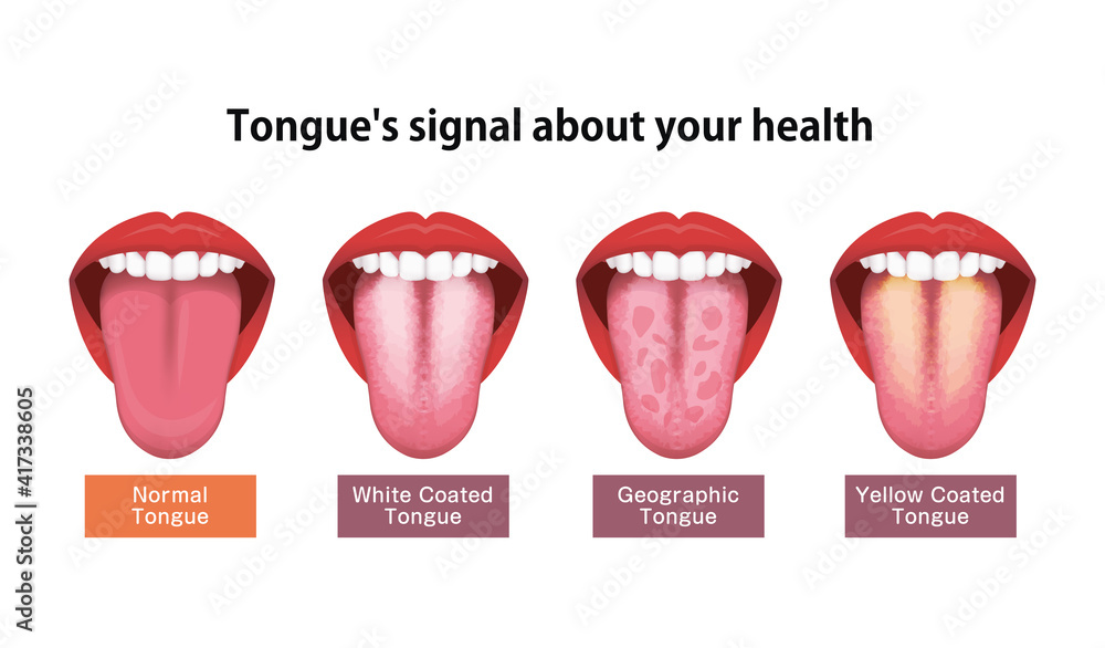 Tongue’s health sign vector illustration ( White coated tongue ) Stock ...