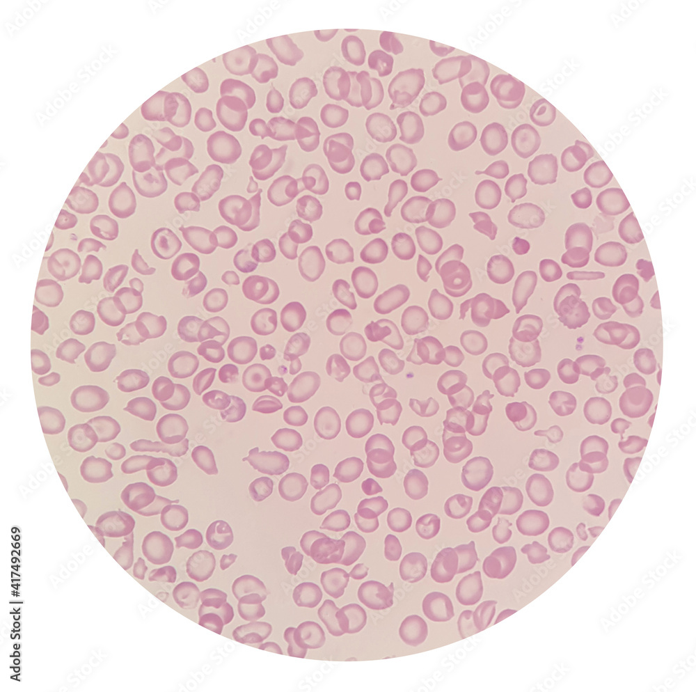 Microscopic images of abnormal red blood cells from thalassemia patient ...