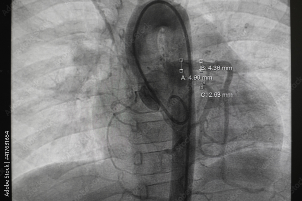 Photo Stock pediatric angiography. Aortography showed patent ductus ...