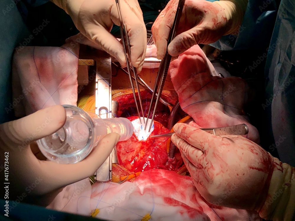 Surgeon used dacron patch for closure of Ventricular septal rupture ...