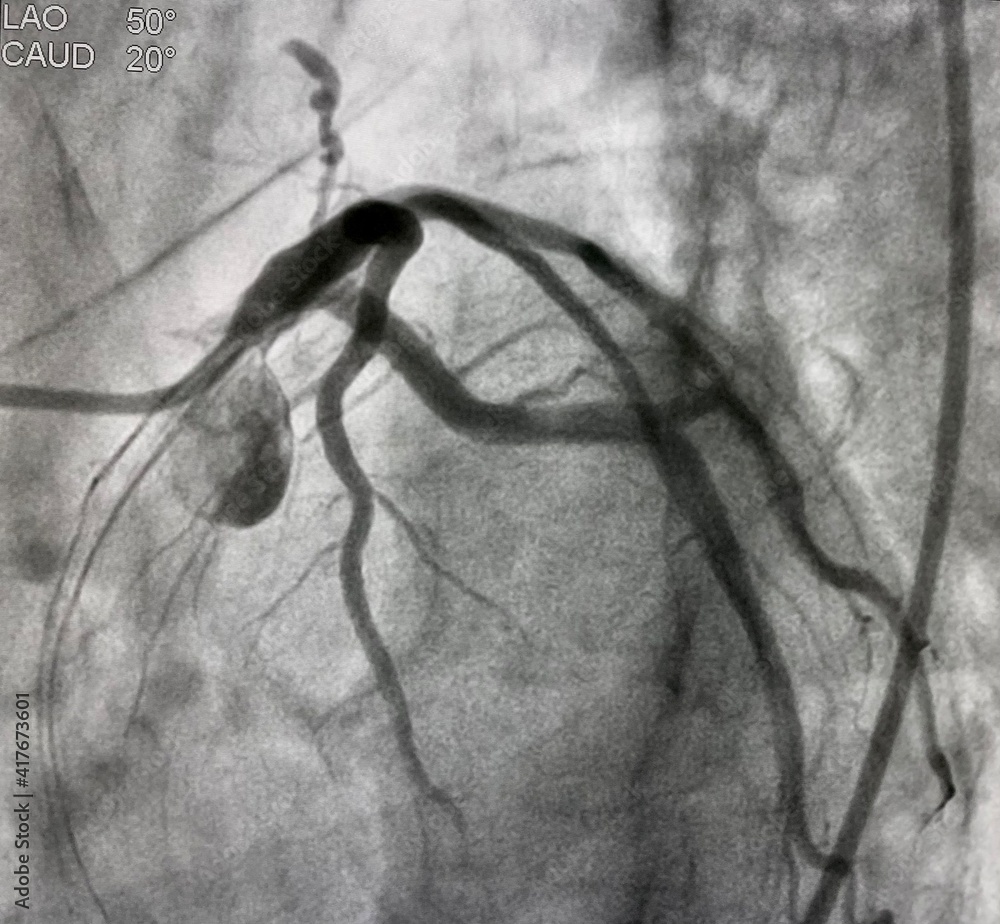 coronary angiogram of left coronary artery with arteriovenous (AV ...
