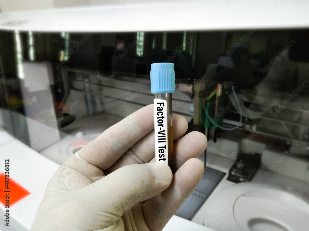 Blood sample for Factor VII or anti-hemophilic factor, diagnosis of ...