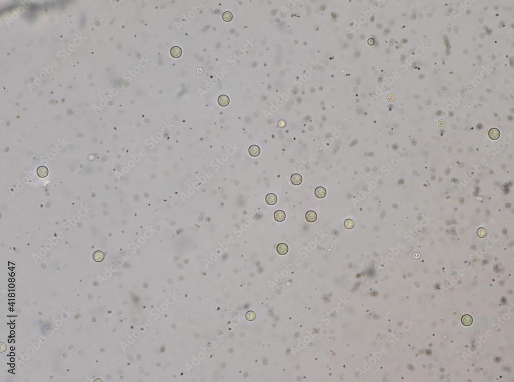 Cryptococcus neoformans is an encapsulated yeast India ink preparetion ...