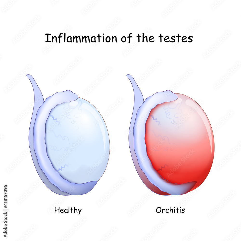 Healthy testicle and testicle with Orchitis Stock Vector | Adobe Stock