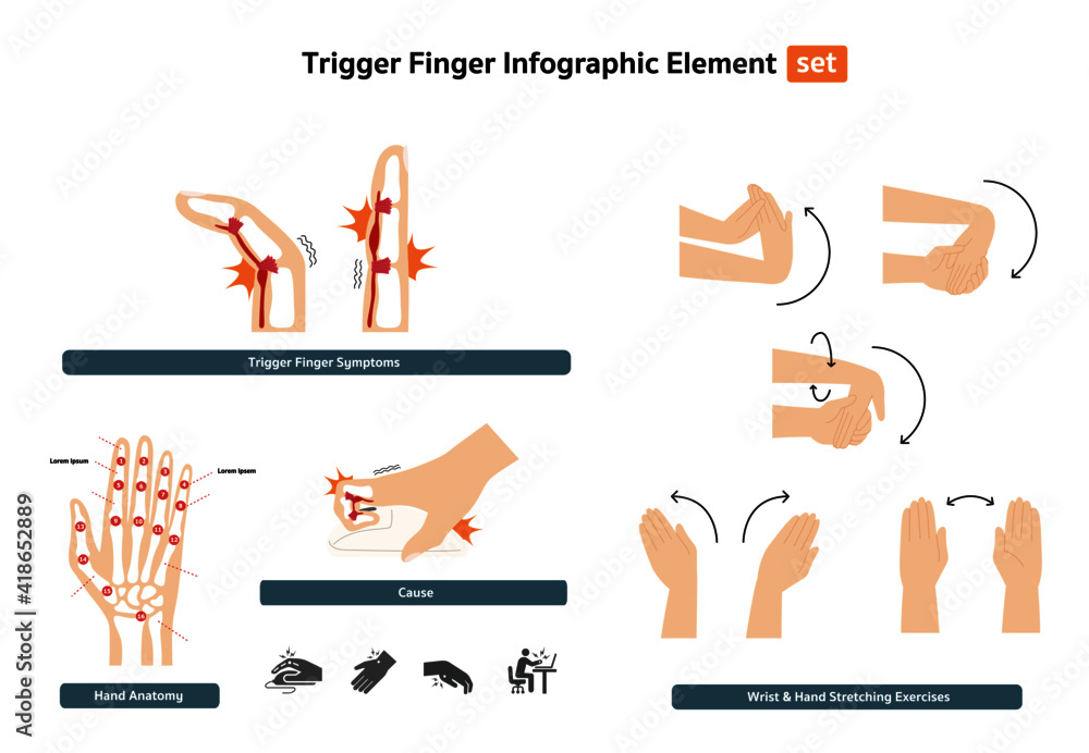 trigger finger infographic element set, office syndrome, finger ...