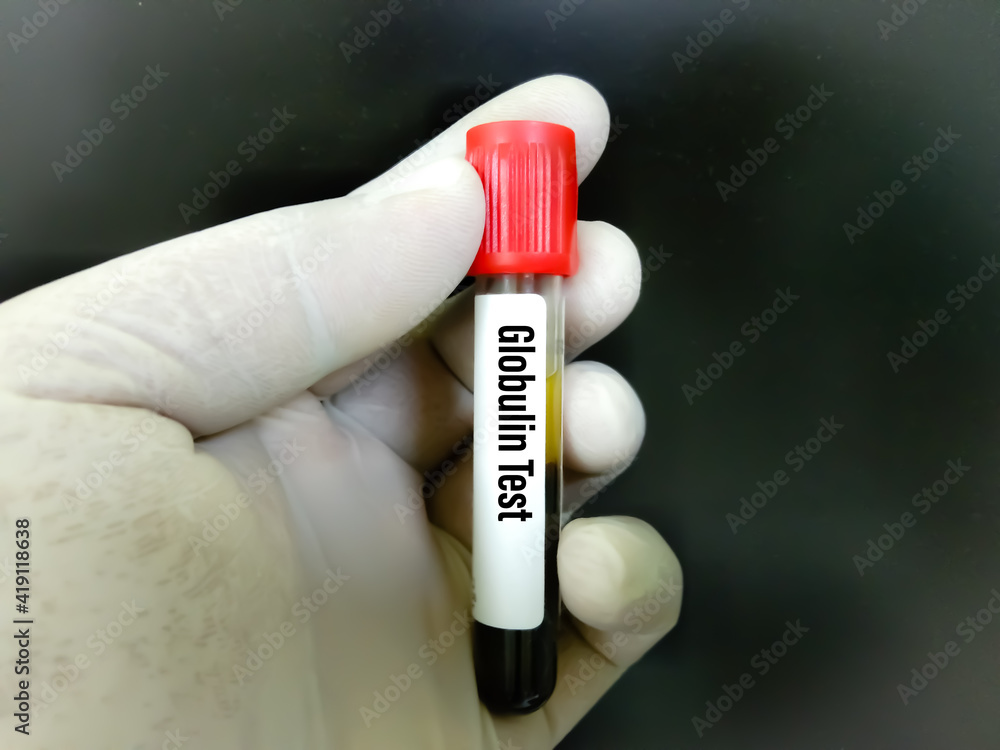 Liver figure, test tubes with blood, liver function test result are ...