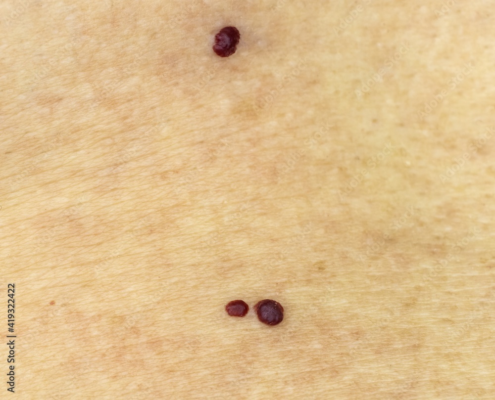 Red moles on Caucasian skin, cherry angioma, senile angioma Stock Photo ...
