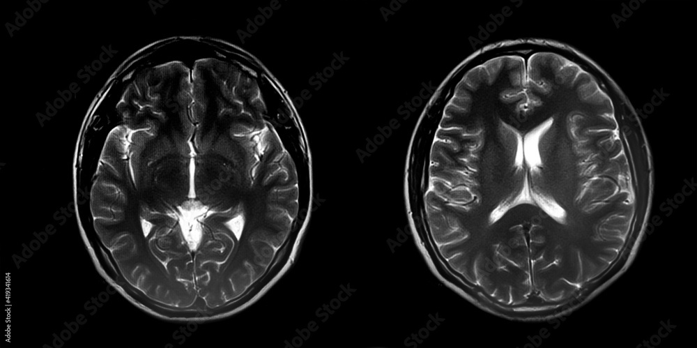 Magnetic resonance image (MRI) of normal brain, panoramic brain ...