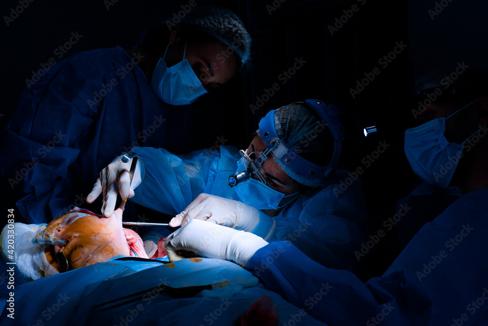 Macs lift surgery. Minimal Access Cranial Suspension Lift plastic ...