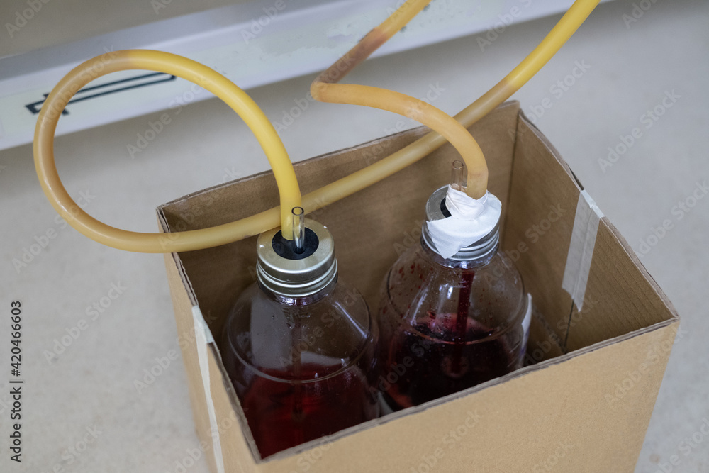 Two bottle system of chest drainage for patient post open heart surgery ...