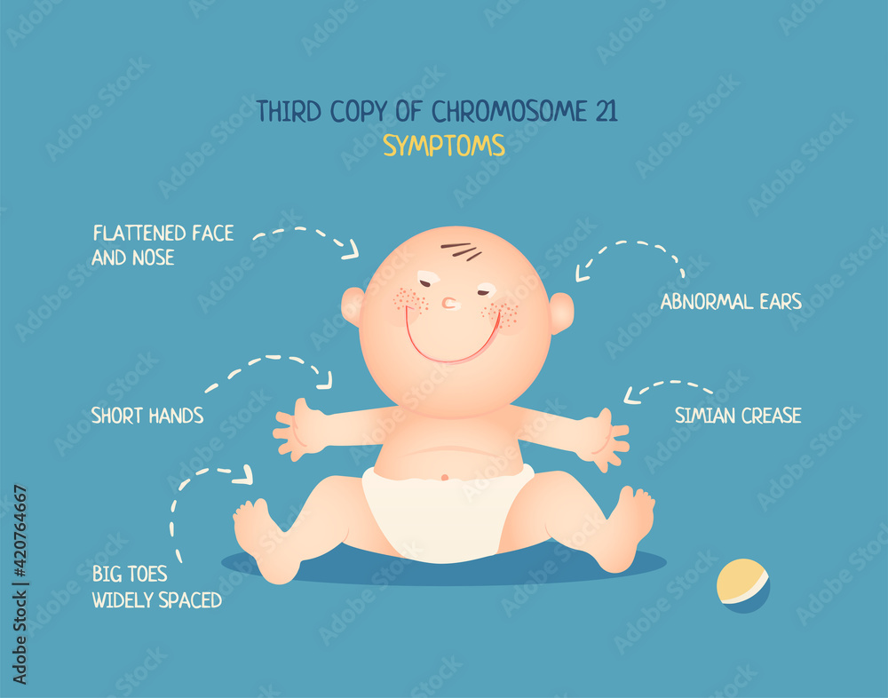 Vector de Stock Down syndrome. Symptoms. Happy cute baby boy with trysomy 21. Poster for world ...