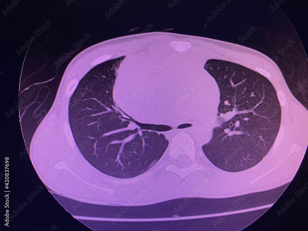 CT scan show heterogeneous mass at interior mediastinum , the mass ...
