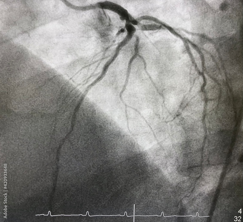 Coronary angiogram shown left anterior descending artery (LAD) stenosis ...