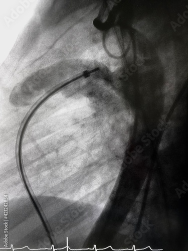 Aortography showed patent ductus arteriosus (PDA) during PDA closure ...