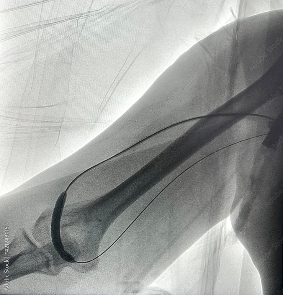 Angiogram shown balloon inflated in hemodialysis arteriovenous fistula ...