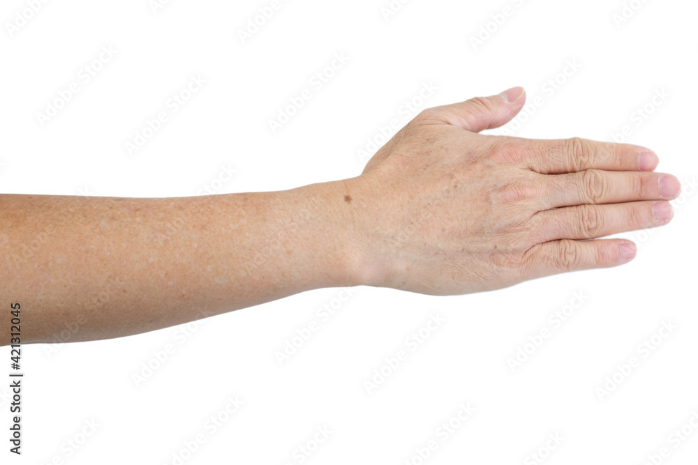 Hypomelanosis