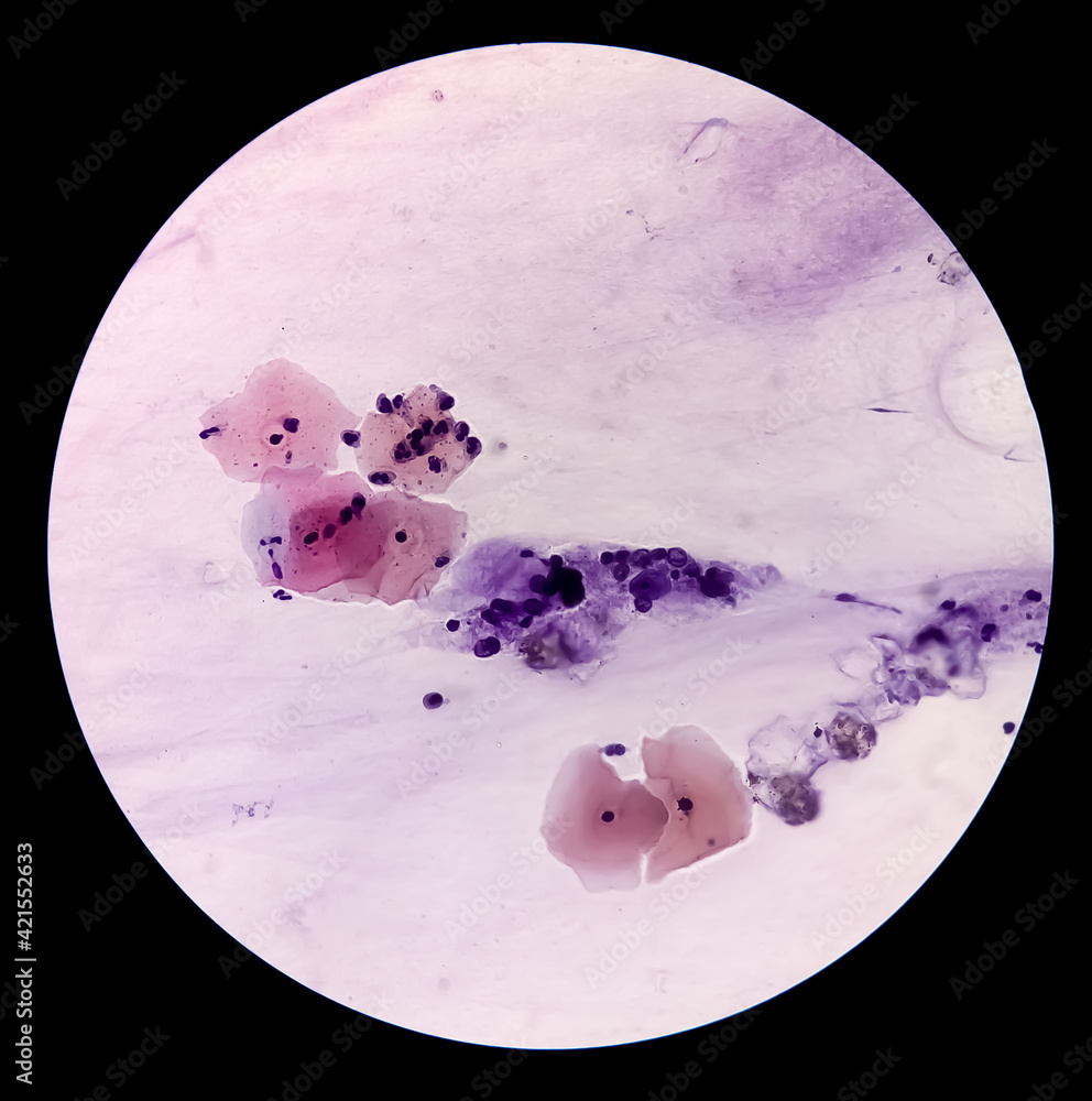 Microscopic view of Histology stained slide. closeup. cell carcinoma ...