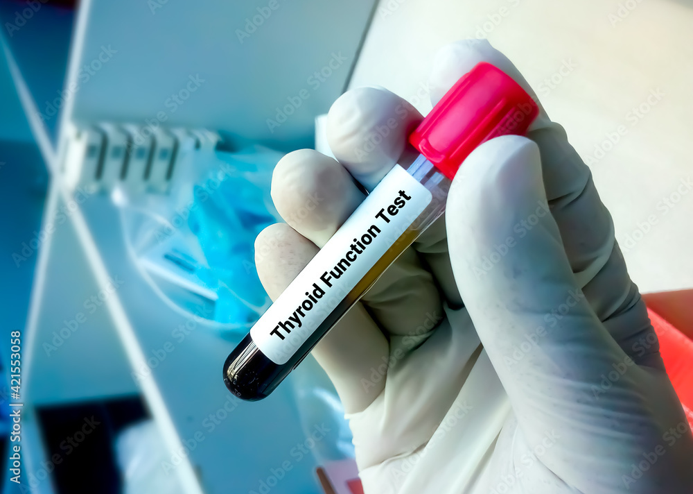 Blood sample in test tubes for hormonal examination of thyroid function ...