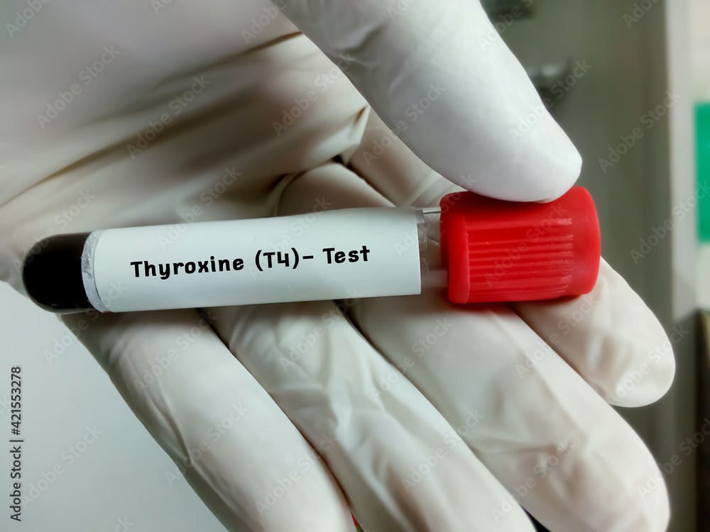 Blood sample in test tubes for hormonal examination of thyroid gland in ...