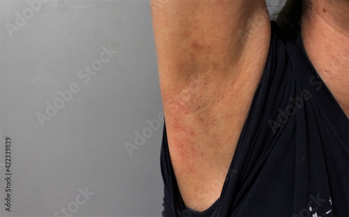 A woman with rash on her underarms, rash on armpit due to deodorant ...