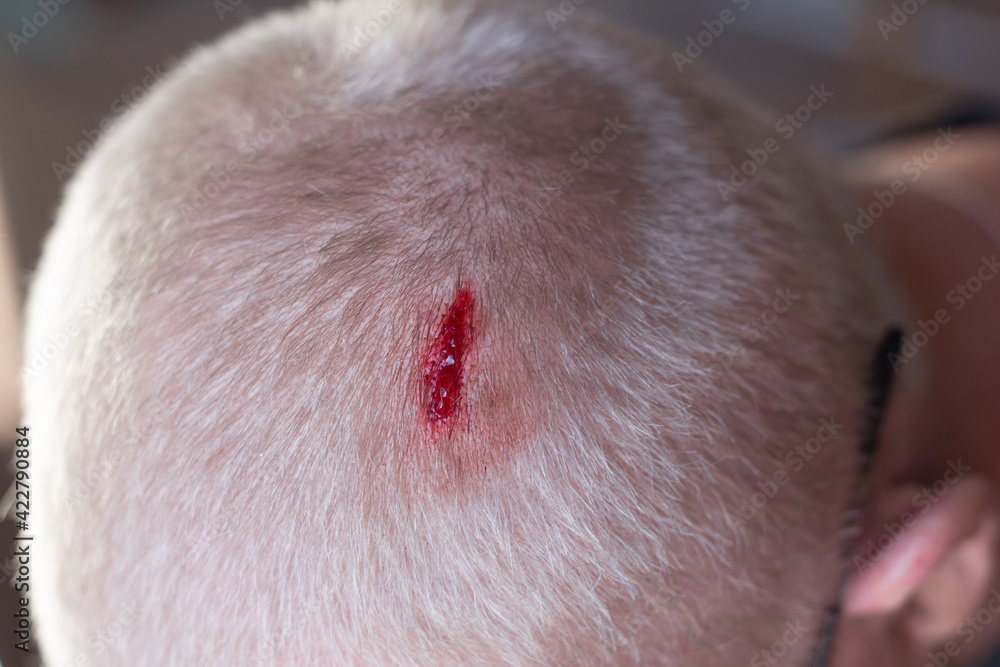 Stock-Foto „Injury to the scalp. Blood escapes from a chopped head ...