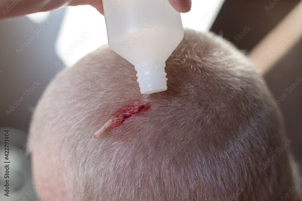 Injury to the scalp. Blood leaks from a chopped wound on the head. The ...
