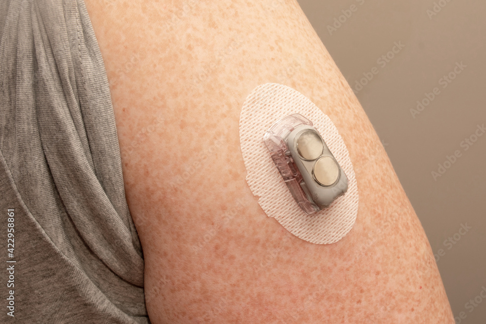 CGM - Continuous glucose monitoring: sensor installed on the upper arm ...