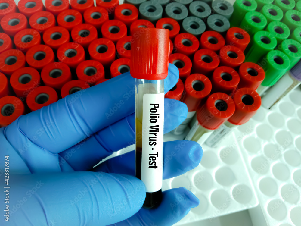 Blood sample for NIPT or Non Invasive Prenatal Testing, diagnosis for ...