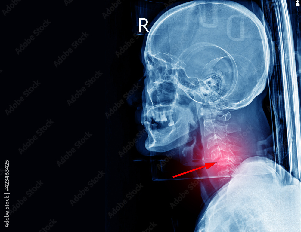 X-ray image of cervical spine case trauma showing C4/5 bilateral facet ...