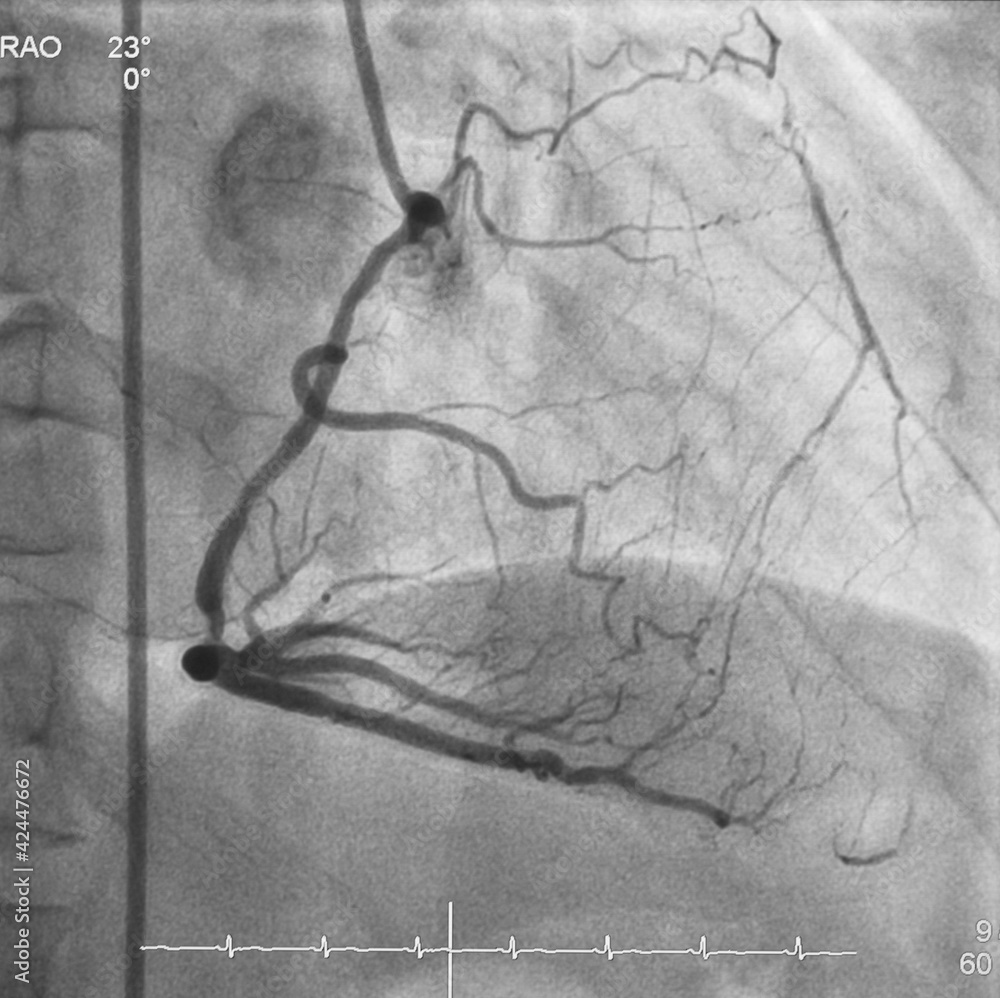 Coronary angiogram (CAG) was performed right coronary artery (RCA ...