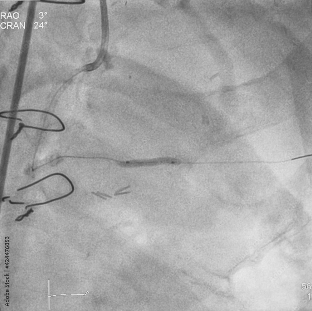 Foto de Stock X ray image performed balloon catheter inflation at ...