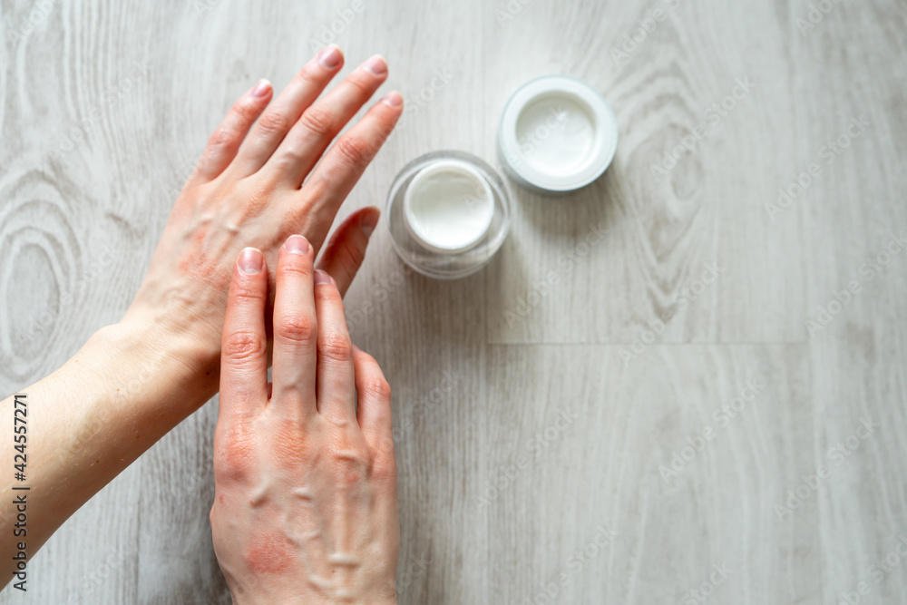 Women's hands smeared with cream. Dermatitis on the hands. Dermatitis ...