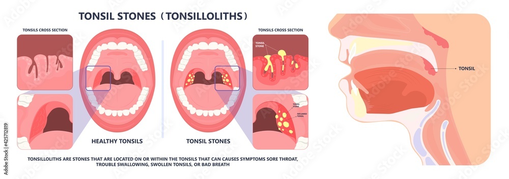 Tonsil Stones crypts viral virus gland strep throat sore enlarged lymph ...