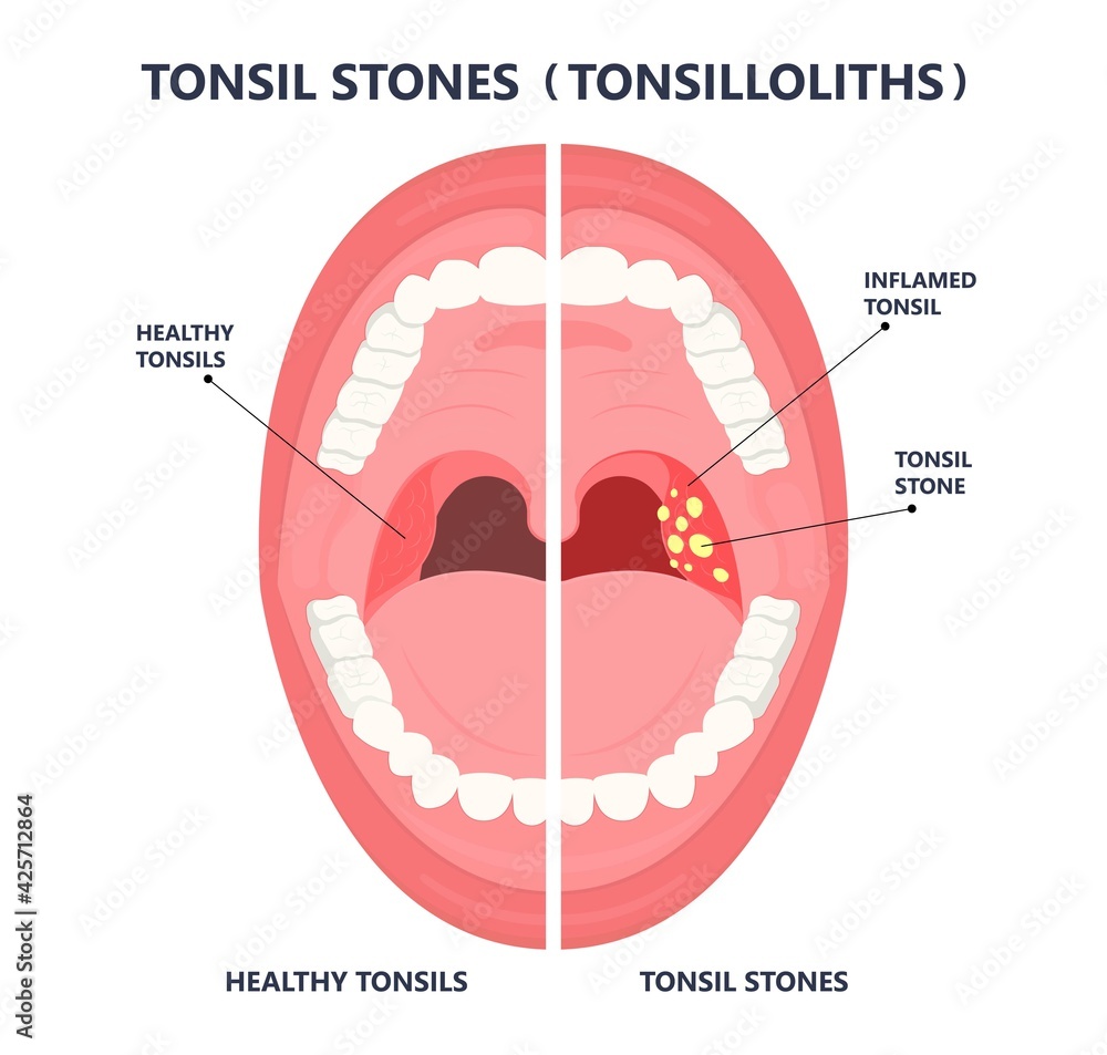 Tonsil Stones crypts viral virus gland strep throat sore enlarged lymph ...