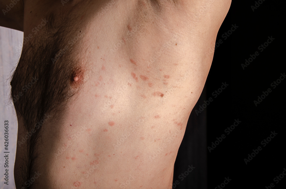 Pityriasis rosea is a type of skin rash Stock Photo | Adobe Stock