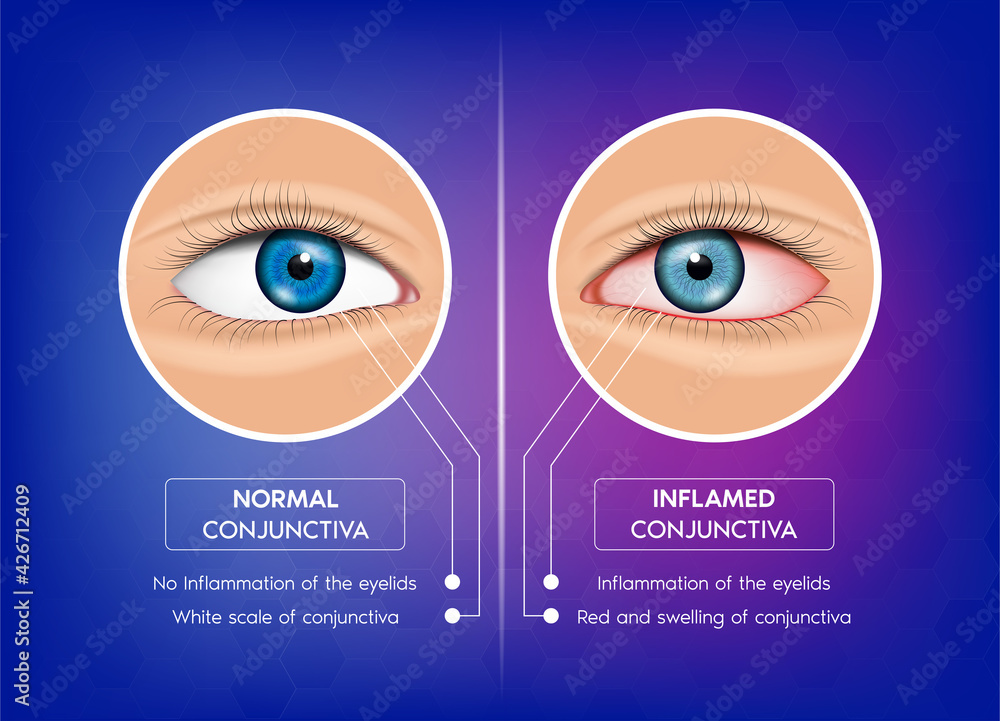 Normal conjunctiva and Conjunctivitis. Healthy eye and pink eye. Most ...
