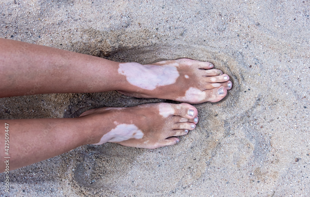 Legs and feet of woman with vitiligo pigment spot disease in the sand ...