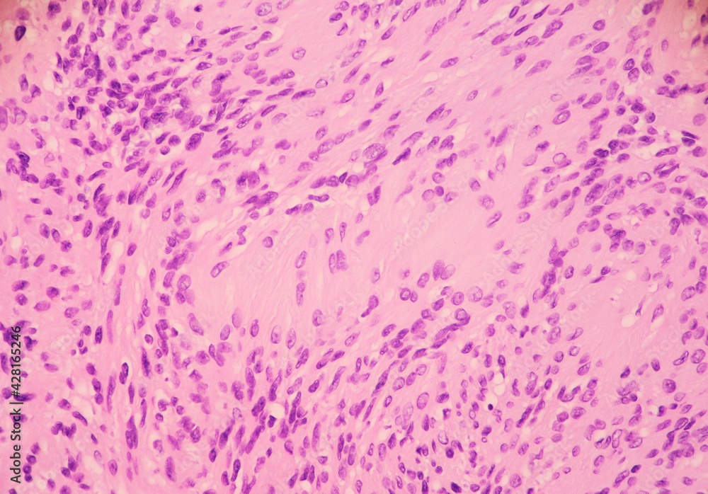 Benign nerve sheath tumor called a Schwannoma. Microscopic view. Stock ...