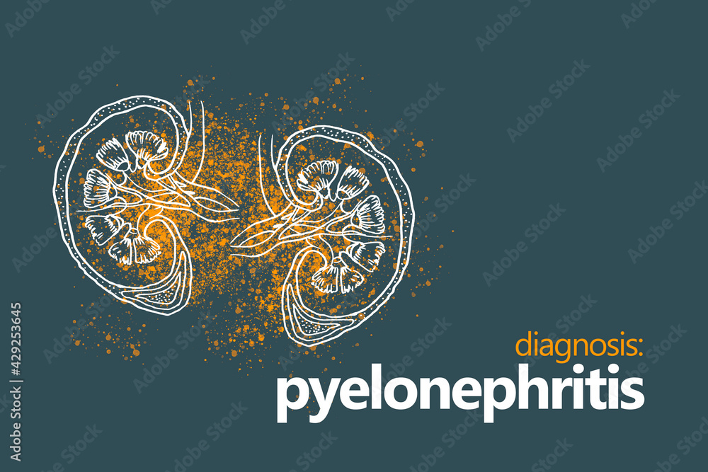 Pyelonephritis, aninflammation of the kidney, typically due to a ...