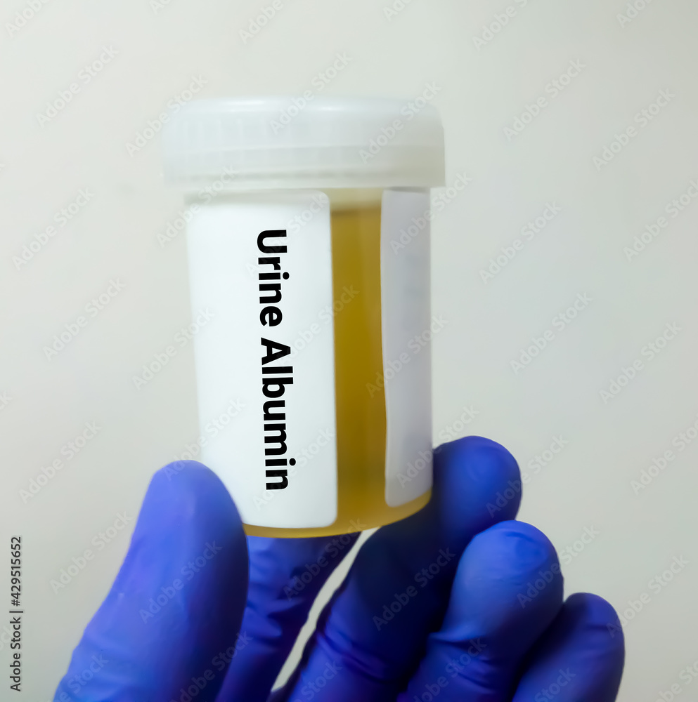 Photo Stock Urine sample for urine albumin test, albuminuria | Adobe Stock
