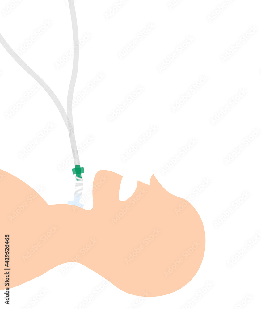 Tracheostomy patient in mechanical ventilation. Filter and circuit ...