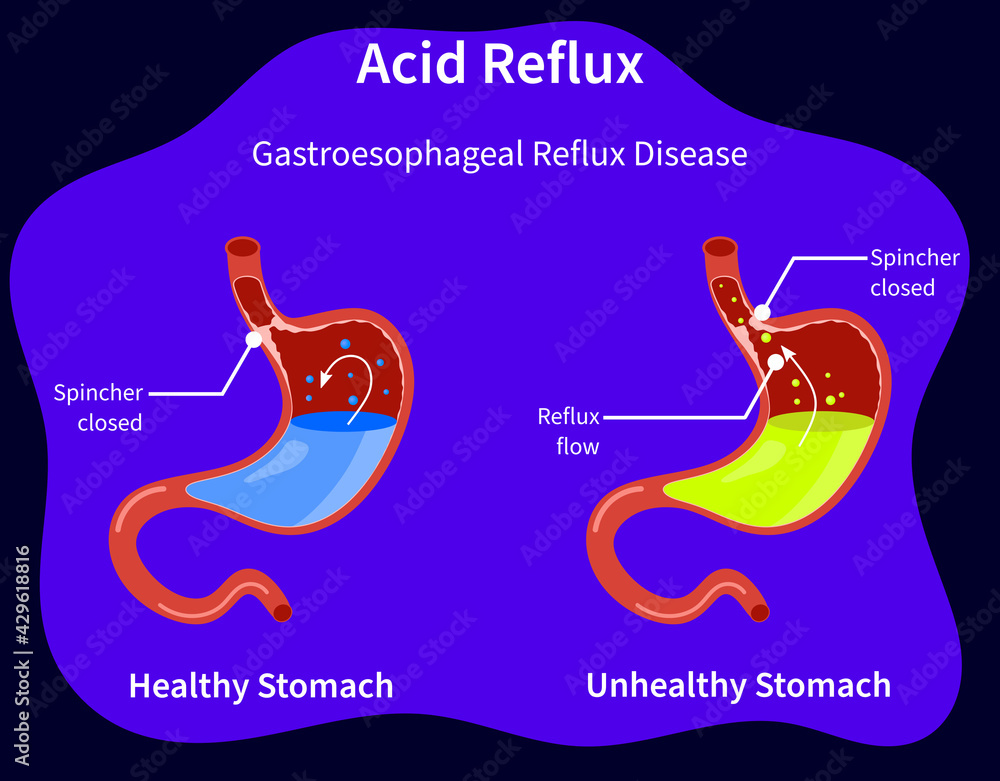 Acid reflux or gastroesophageal reflux, Heartburn. Gastric disease ...