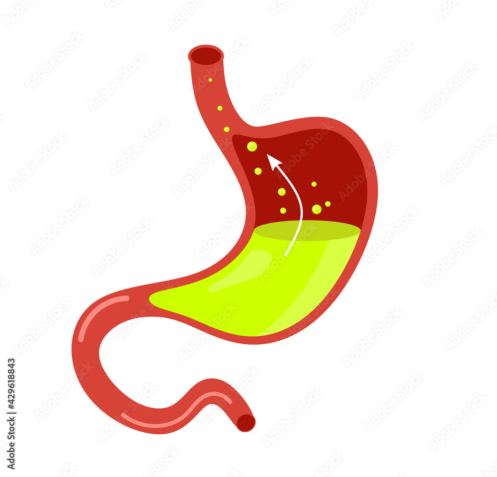 Acid reflux or gastroesophageal reflux, Heartburn. Gastric disease ...